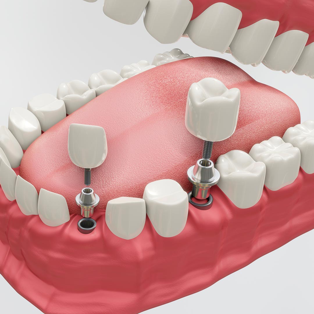 Implante Protocolo - ProQuality Odontologia SJC - Implantes Dentários